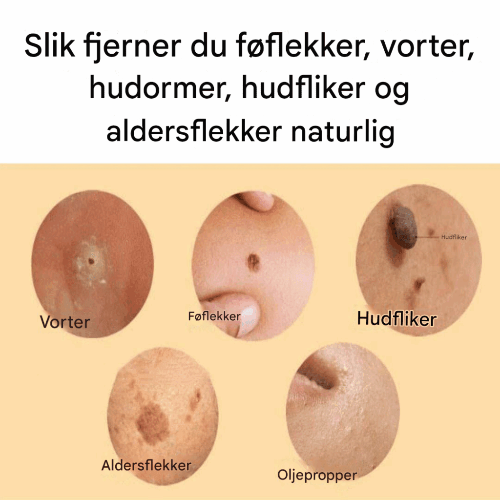 Naturlig hudpleie: Hva kan du prøve for å fjerne aldersflekker ...